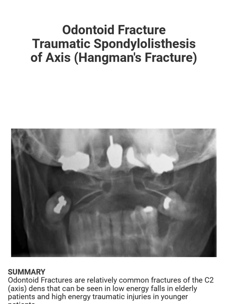 Odontoid Fracture | PDF | Vertebral Column | Vertebra