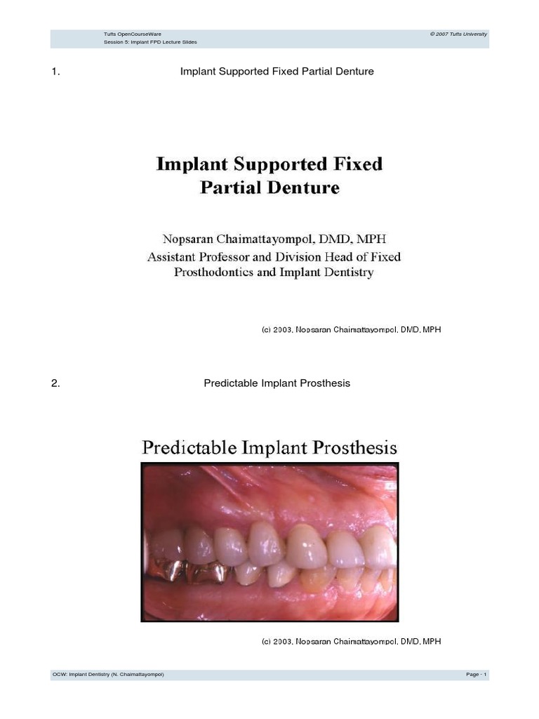 Implant Supported FPD | PDF