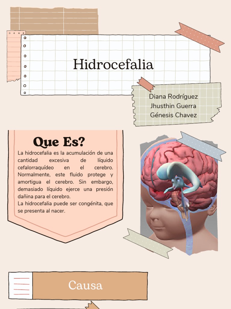 Hidrocefalia | PDF | Sistema nervioso | Medicina CLINICA