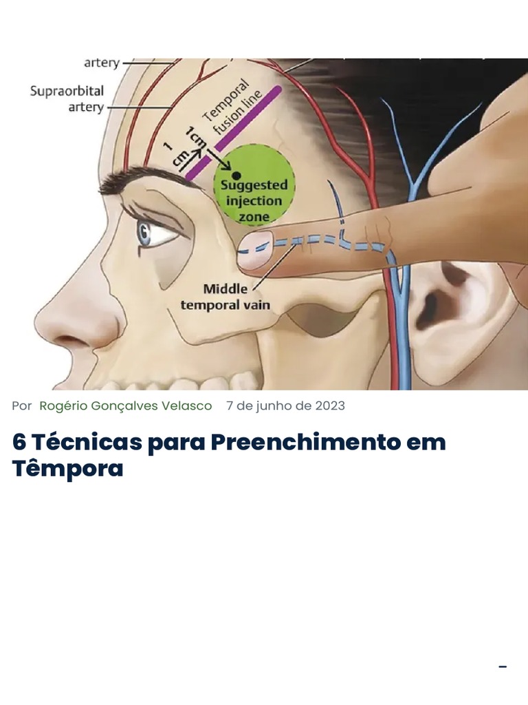 6 Técnicas para Preenchimento em Têmpora Instituto Velasco | PDF | Artéria | Pele