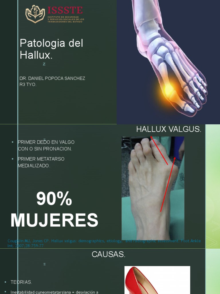 Patología y Tratamiento del Hallux Valgus | PDF | Dedo del pie | Pie