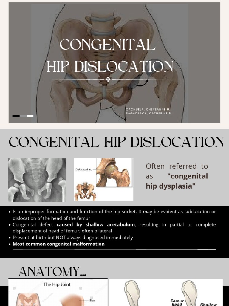 Congenital-Hip-Dislocation Isu | PDF