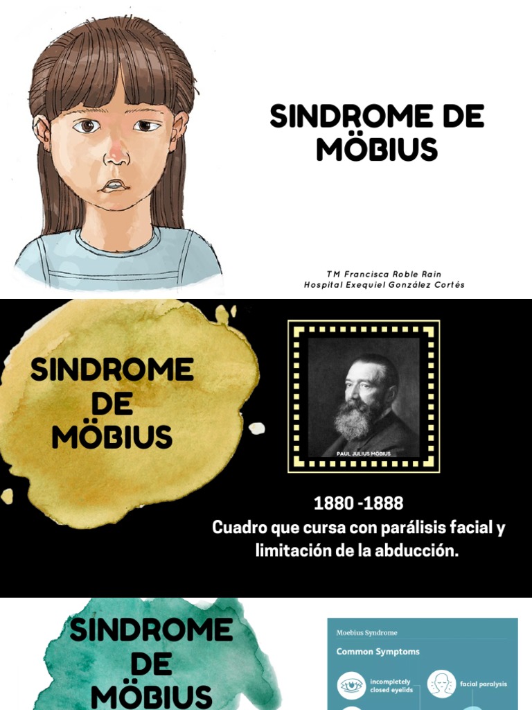 Sindrome de Möbius - Original | PDF | Sistema nervioso | Oftalmología