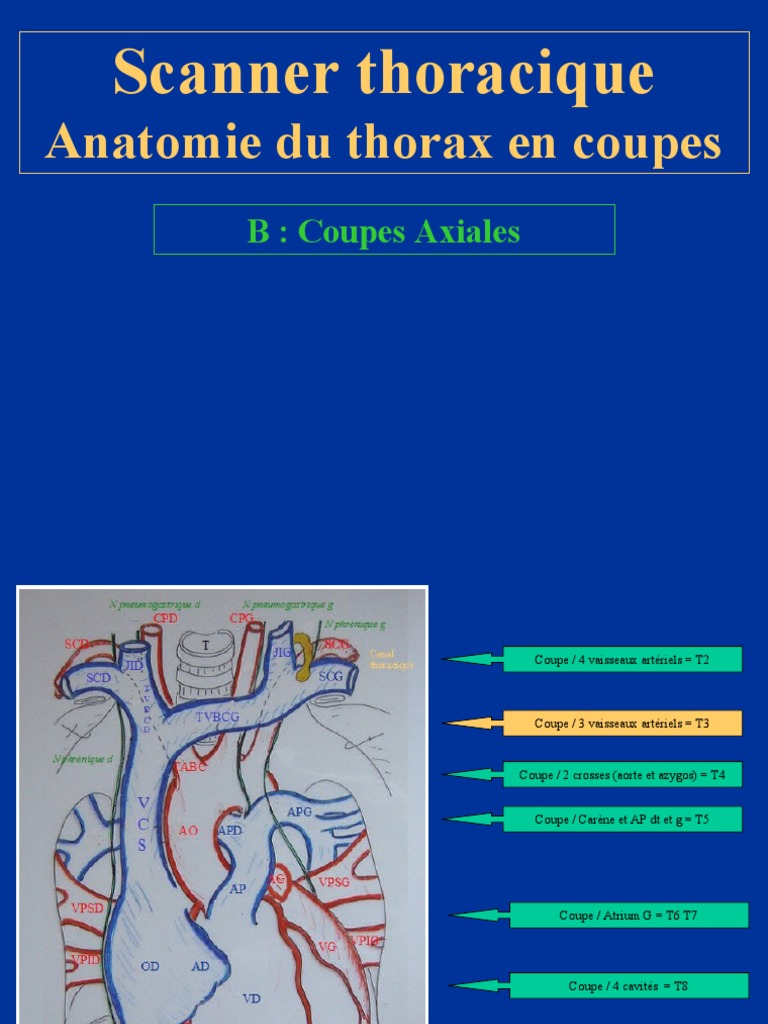 TDM Thoracique | PDF | Aorte | Thorax