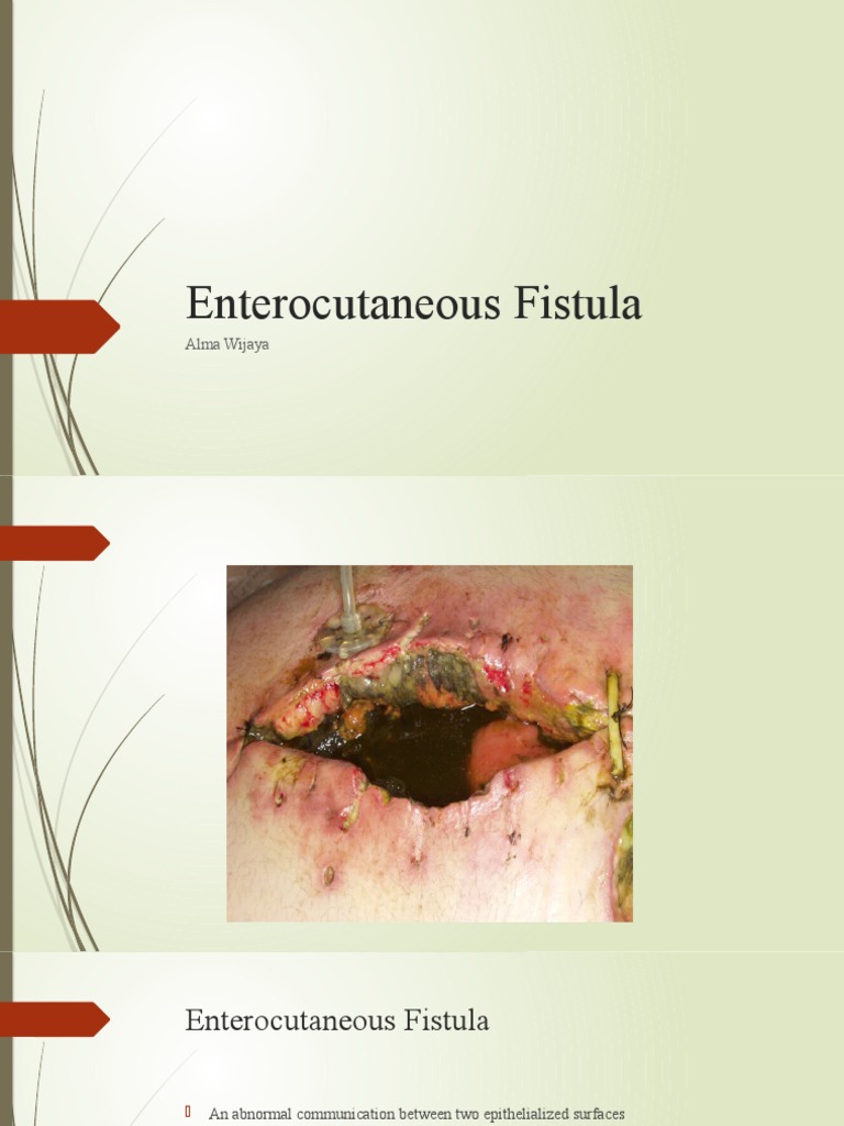 Enterocutaneous Fistula | PDF | Gastrointestinal Tract | Surgery