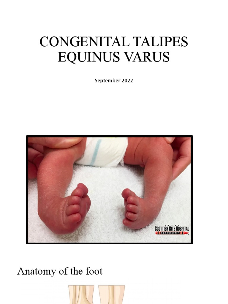 Club Foot | PDF | Foot | Human Diseases And Disorders