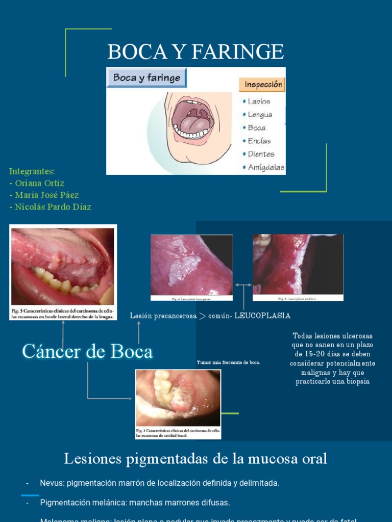 Cáncer de Boca, Pelsiones Pigmentarias de Mucosa Oral y Faringe | PDF ...