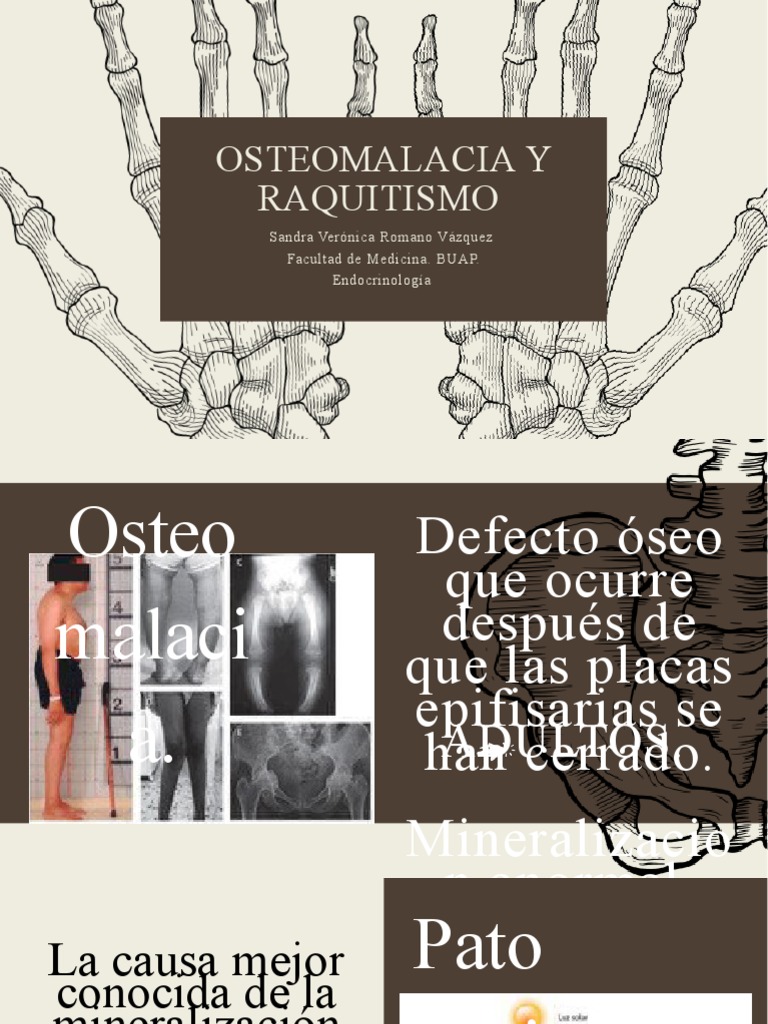 OSTEOMALACIA Y RAQUITISMO | PDF | Vitamina D | Calcio