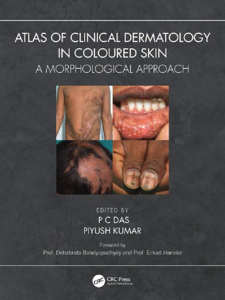 Atlas of Clinical Dermatology in Coloured Skin 2023 Pgs 678 | PDF ...