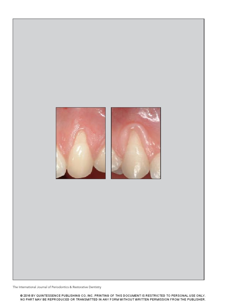 Colgajo Desplazado Coronal para Recesiones Unitarias Forma Tringular Vs ...