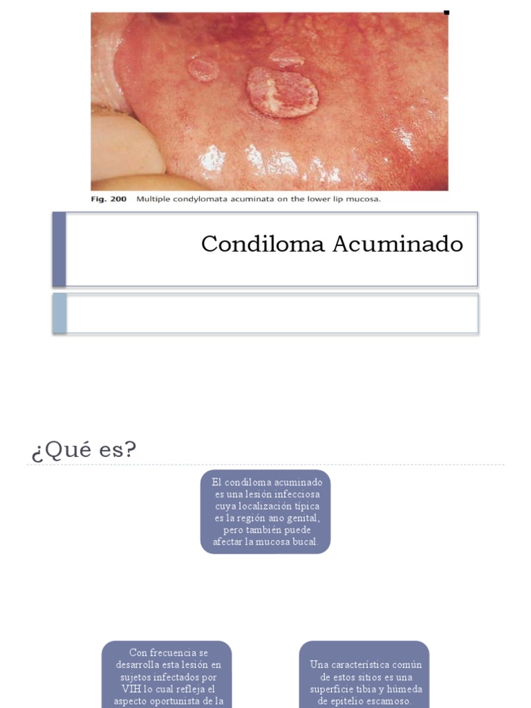 Condiloma Acuminado y Tratamiento | PDF | Epidemiología ...