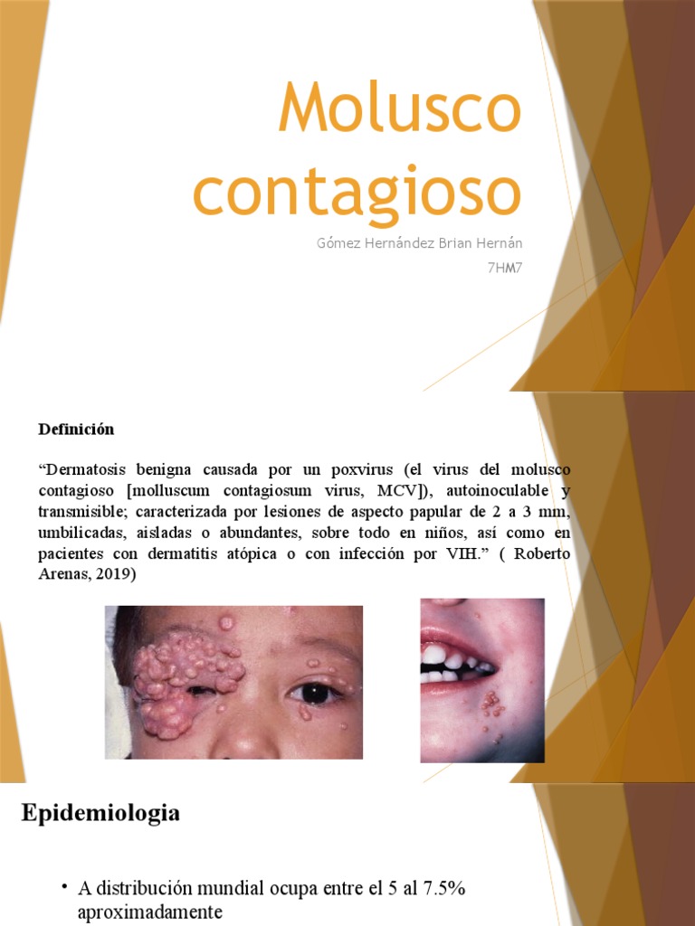 Molusco Contagioso | PDF | Infección transmitida sexualmente | VIH / SIDA