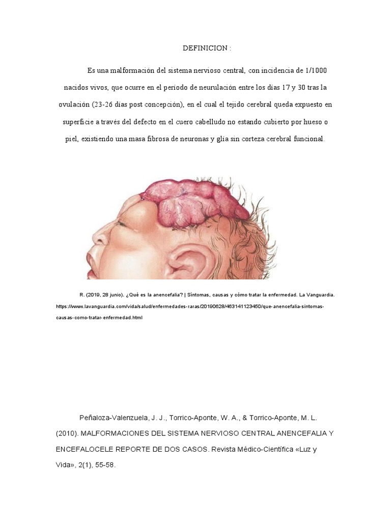DEFINICION Anencefalia | PDF