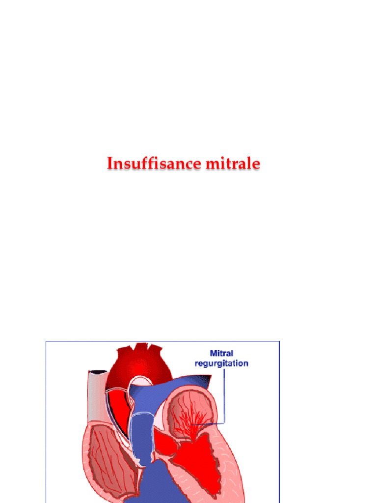 2-Insuffisance Mitrale | PDF | Médecine interne | Spécialités médicales