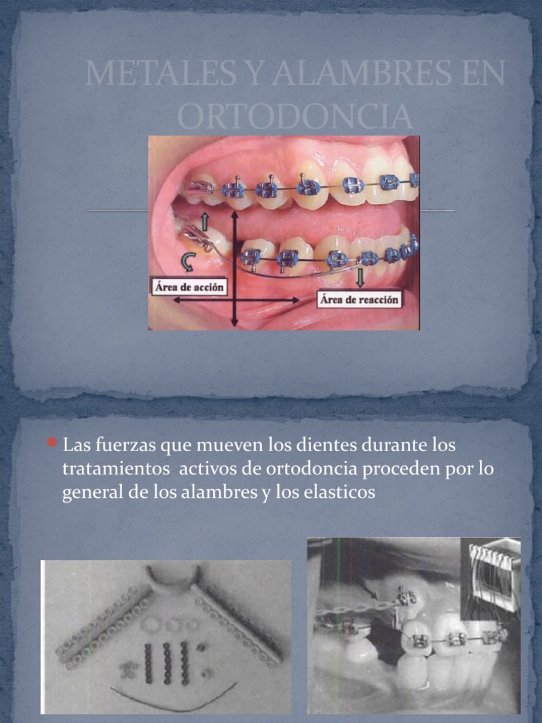 Tipos y propiedades de alambres en ortodoncia | PDF | Ortodoncia | Titanio