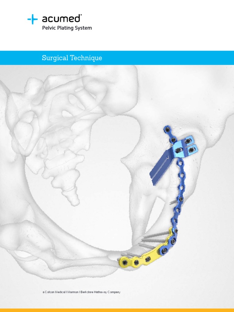 Acumed Surgical Technique en Pelvic Plating System TMA10 00 J | PDF