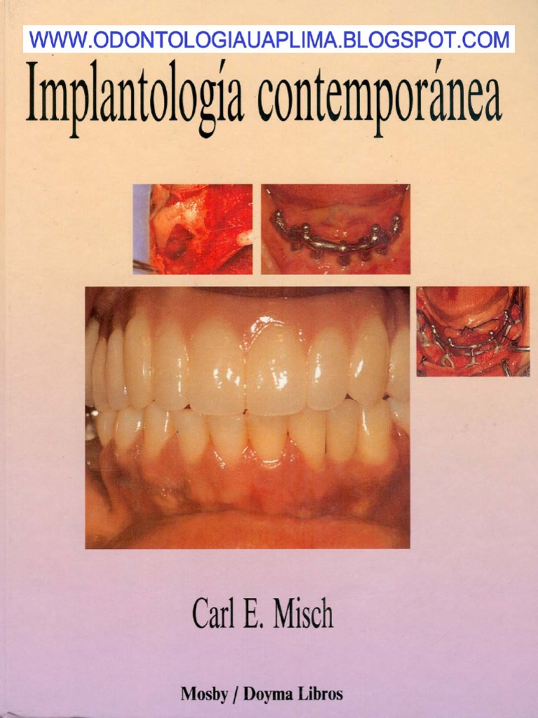 Implantología Contemporanea. Misch | PDF