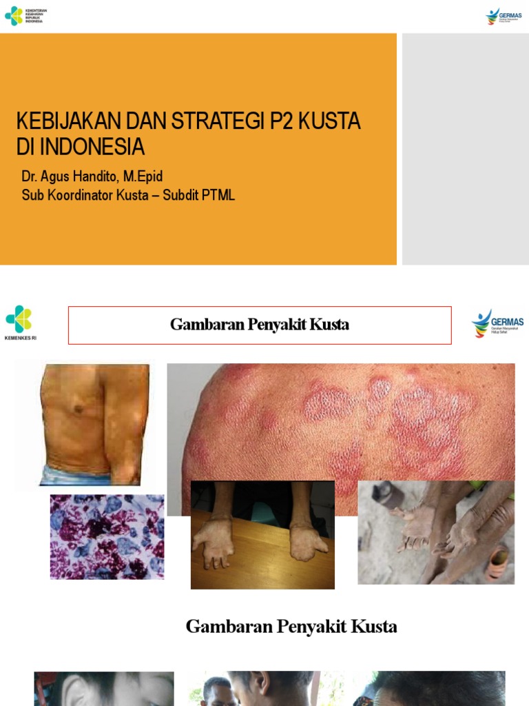 Kebijakan Kusta Cirebon | PDF