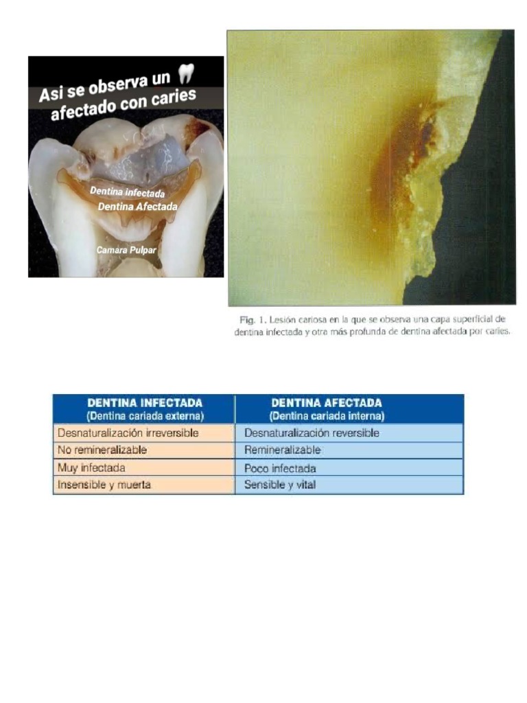 Dentina Afectada e Infectada | PDF