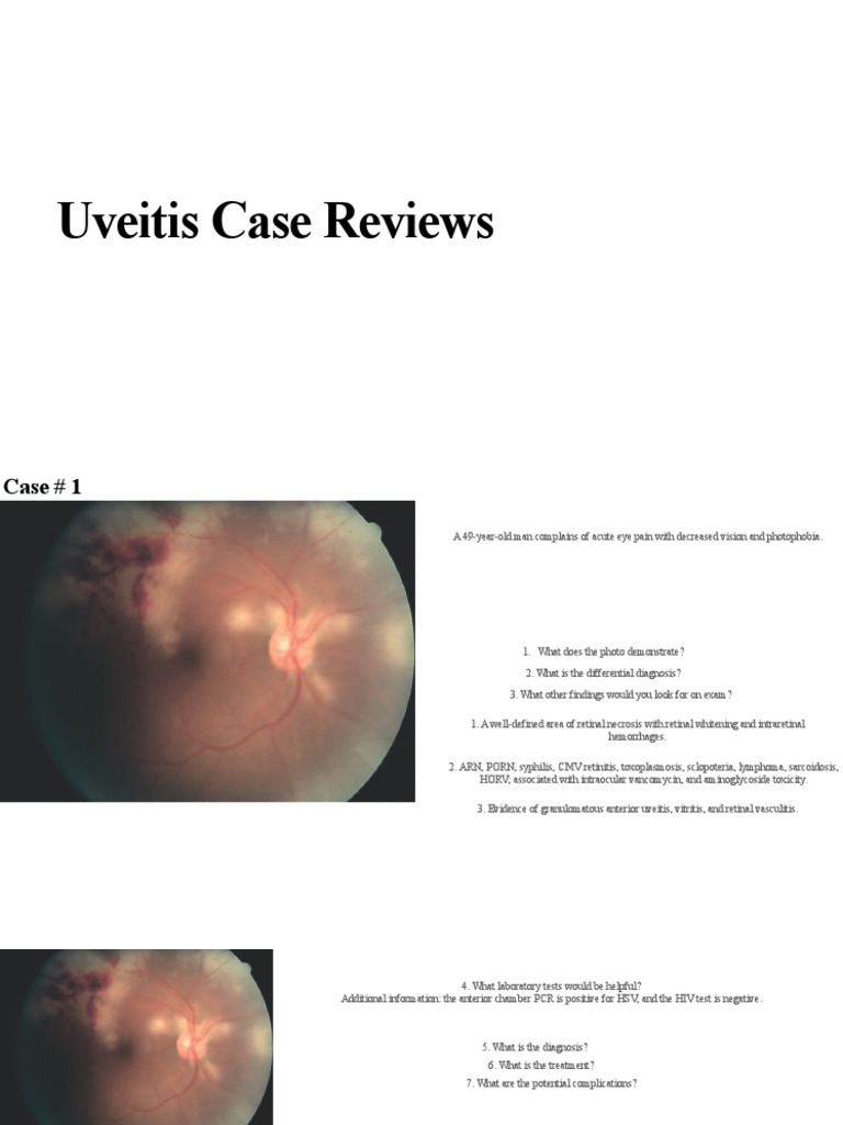 Differentiating ARN and PORN in Uveitis | PDF | Causes Of Death ...