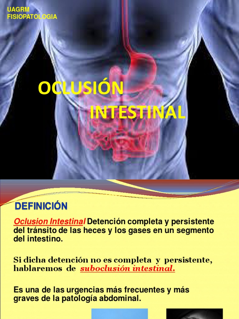 Oclusión Intestinal: Causas y Tratamiento | PDF | Tracto ...
