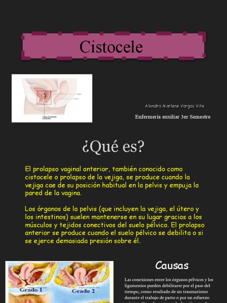 Cistocele Presentación | PDF | Pelvis | Medicina CLINICA