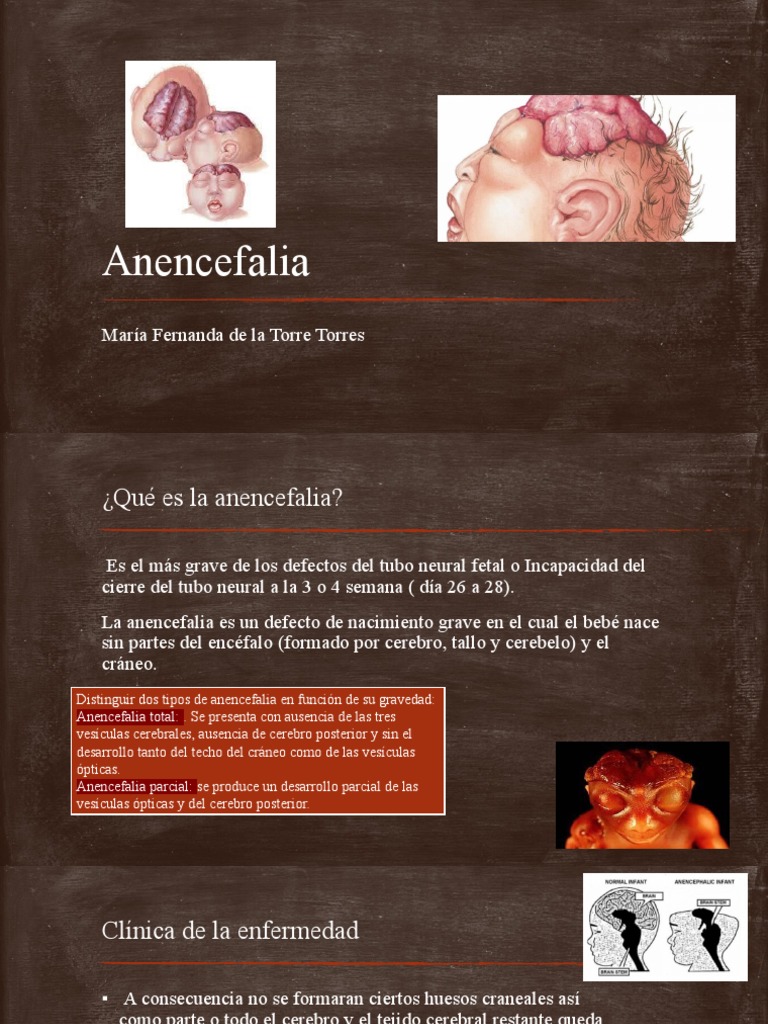 Anencefalia | PDF | Anatomía | Enfermedades y trastornos