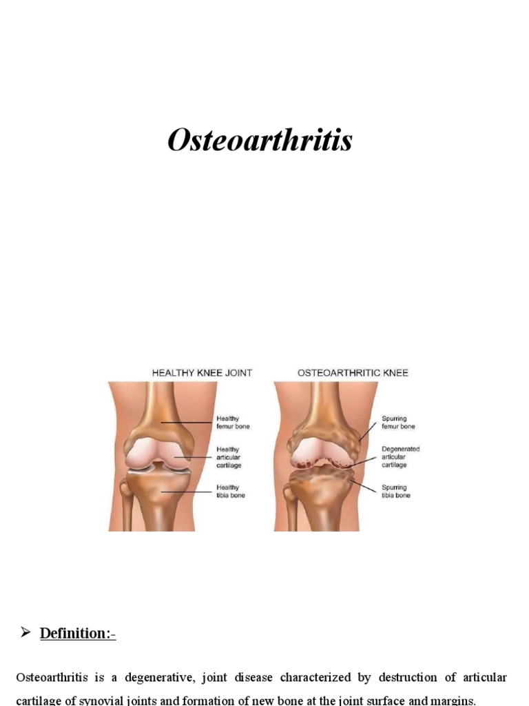 Osteoarthritis 2 | PDF | Knee | Hip
