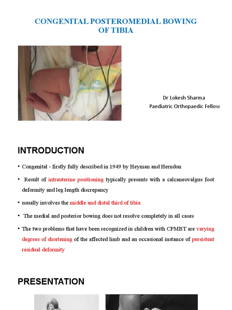 Congenital Posteromedial Bowing | PDF | Ankle | Surgery