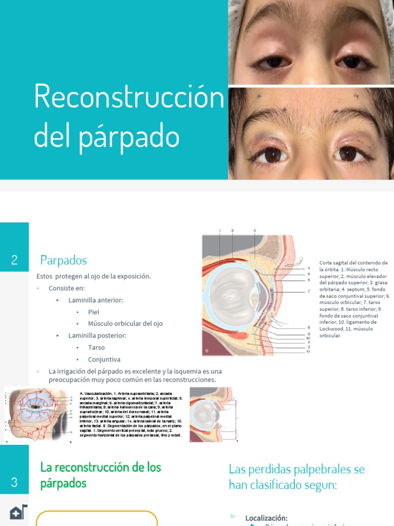 Reconstrucción Del Parpado | PDF