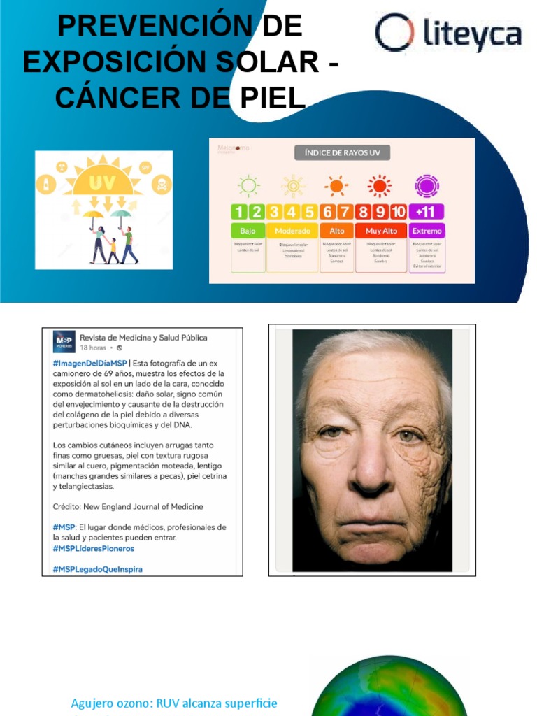 Prevención de Exposición Solar - Liteyca | PDF | Ultravioleta ...