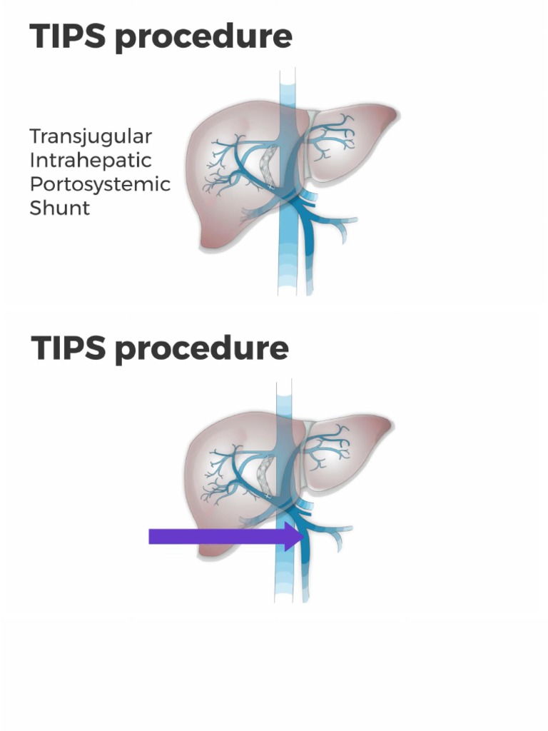 Tipss, Transjugular Intrahepatic Porto-Systemic Shunt | PDF
