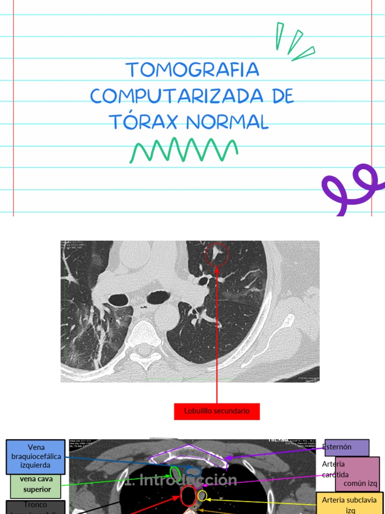 2.1 Tórax Normal | PDF