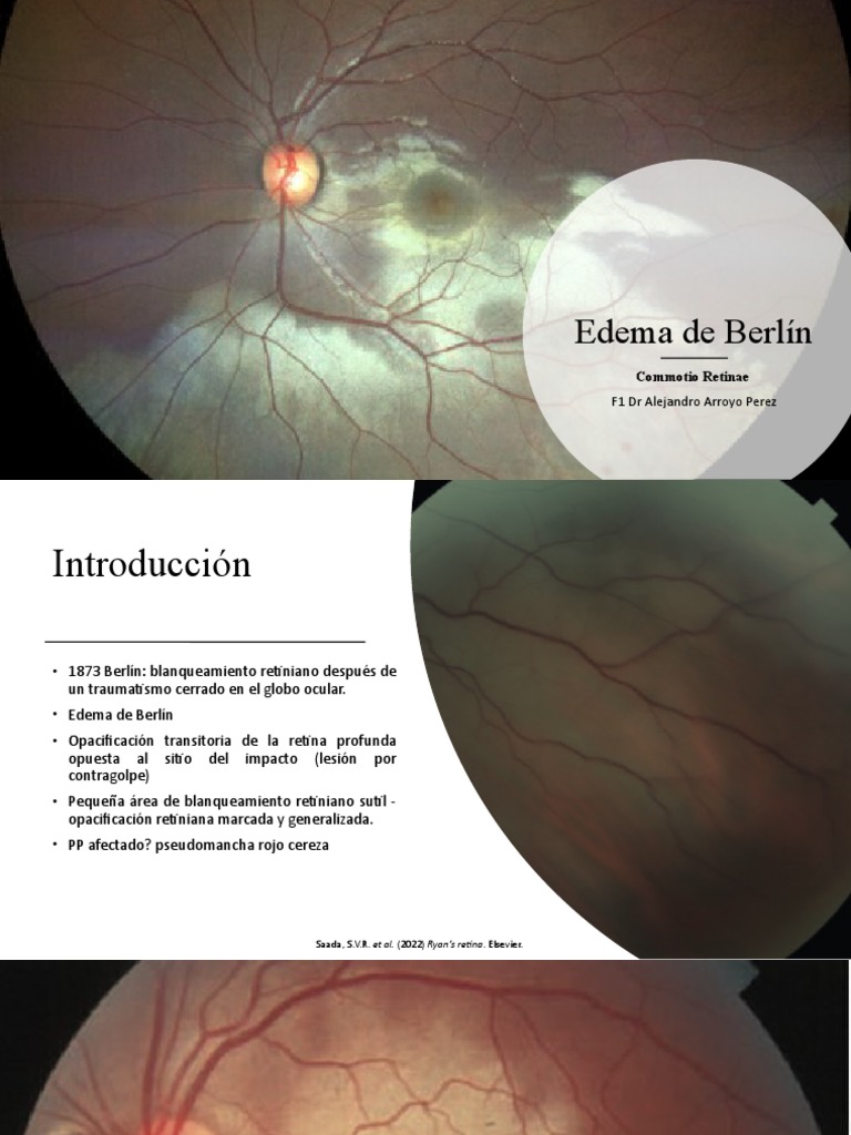 Commotio Retinae Edema de Berlin | PDF | Medicina | Ojo humano
