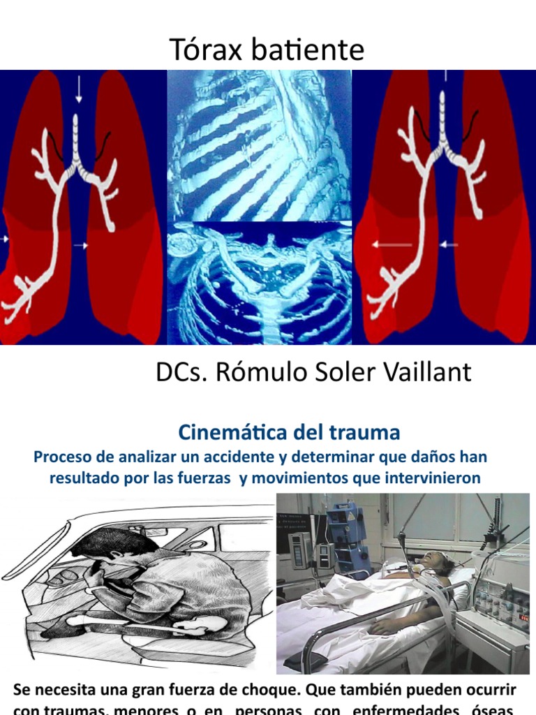 Tórax Batiente: Trauma y Fisiopatología | PDF | Lesión | Tórax