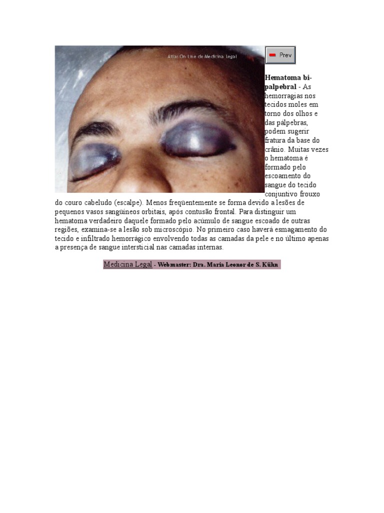 Hematoma Bipalpebral | PDF
