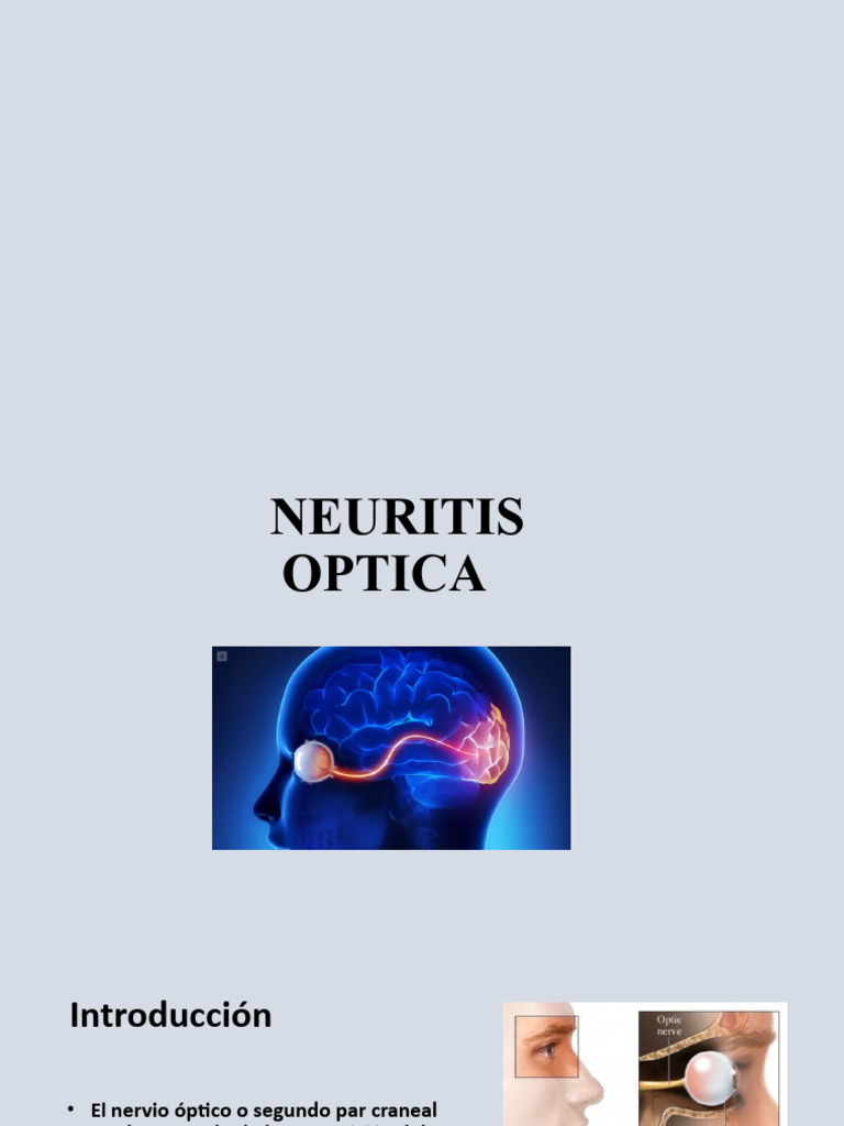 Neuritis Optica Expo Pdf Mielina Esclerosis Múltiple
