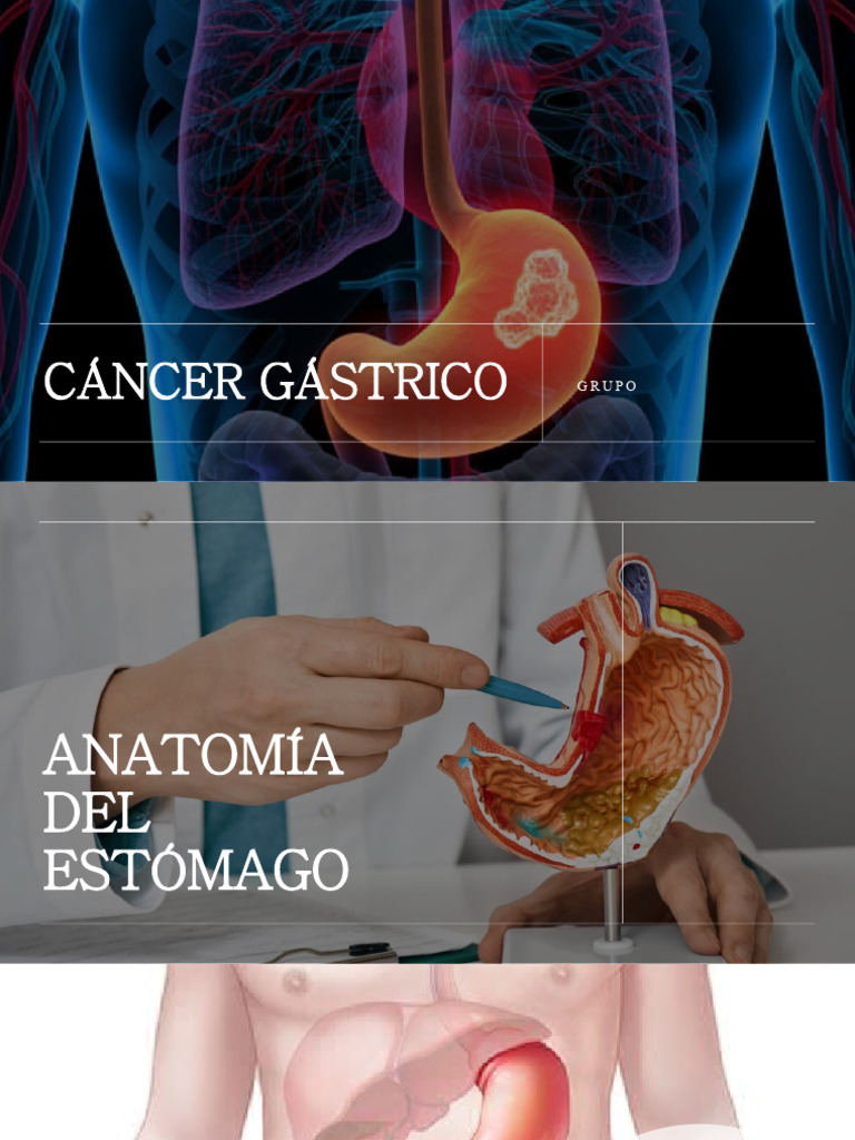 Cáncer Gástrico Diapos | PDF | Estómago | Anatomía