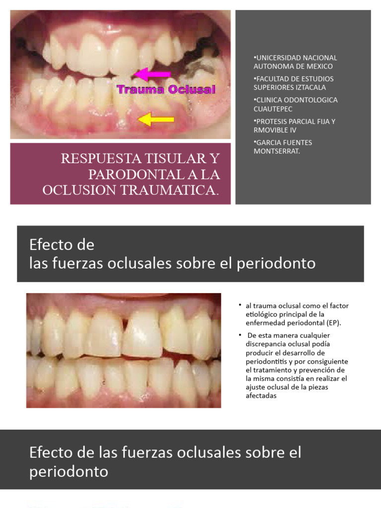 Trauma Oclusal y Respuesta Periodontal | PDF | Odontología | Ciencias ...