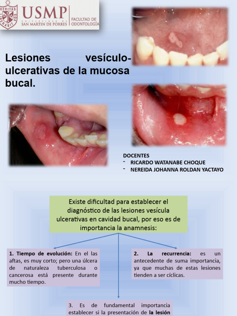Lesiones Vesículo Ulcerativas de La Mucosa Bucal | PDF | Herpes Simple ...