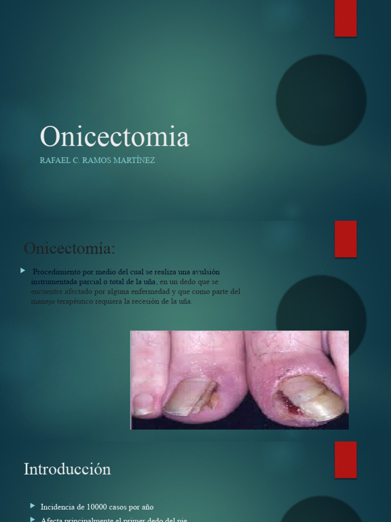 Onicectomia | PDF | Clavo (anatomía) | Dedo del pie