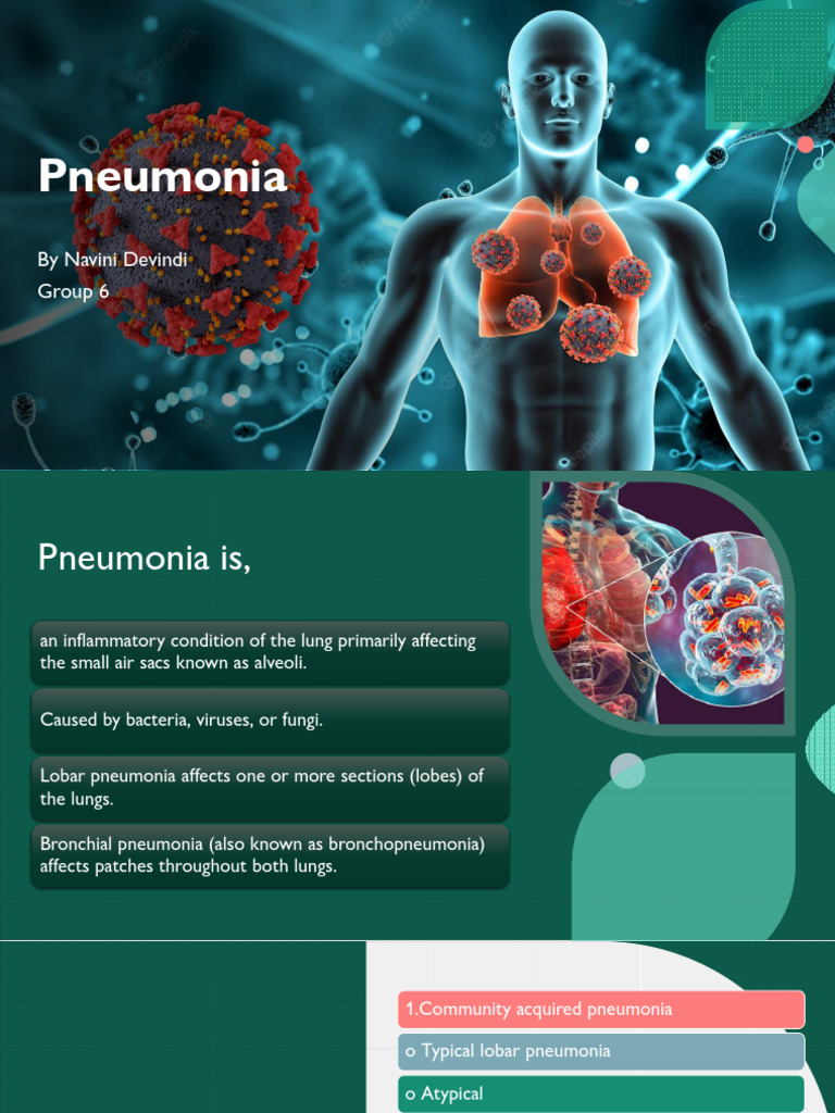 Pneumonia PPT New | Download Free PDF | Pneumonia | Influenza