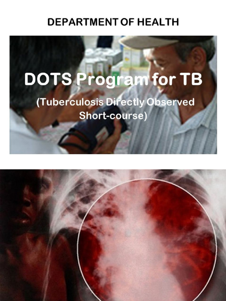 National TB Program | PDF