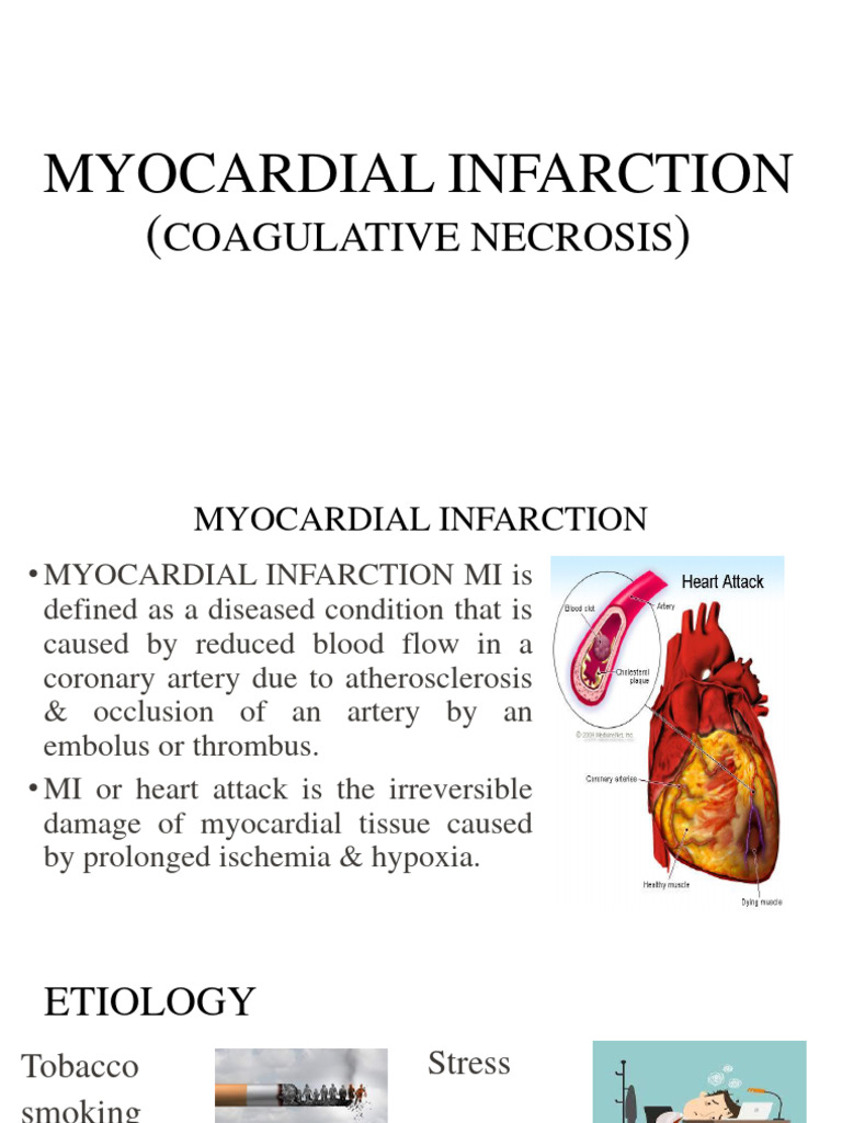 Acute MI | PDF