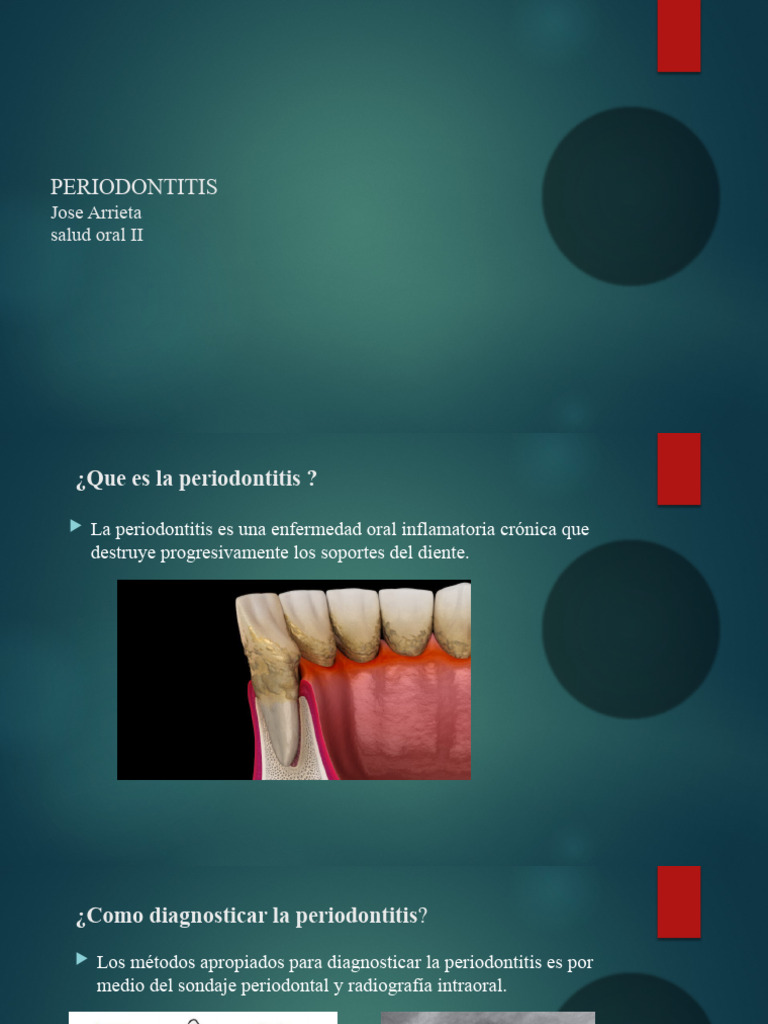 PERIODONTITIS | PDF | Especialidades Medicas | Medicina CLINICA