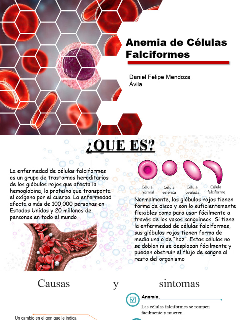Anemia de Células Falciformes | PDF | Anemia | Glóbulo rojo