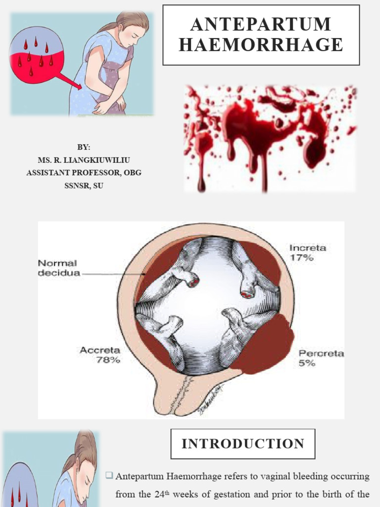 Antepartum Haemorrhage: BY: Ms. R. Liangkiuwiliu Assistant Professor ...