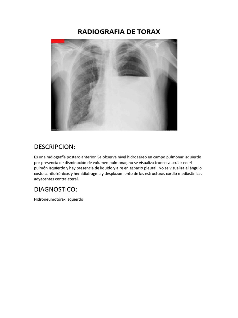 Radiografia de Torax | PDF