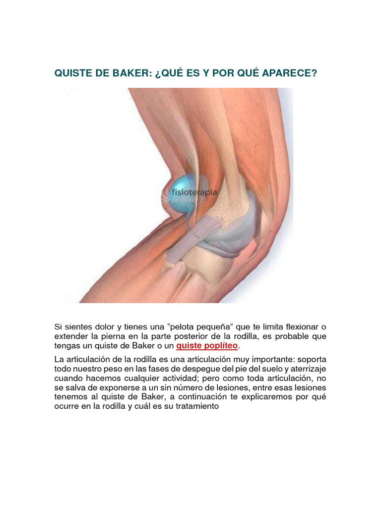 Quiste de Baker | PDF | Rodilla | Articulación