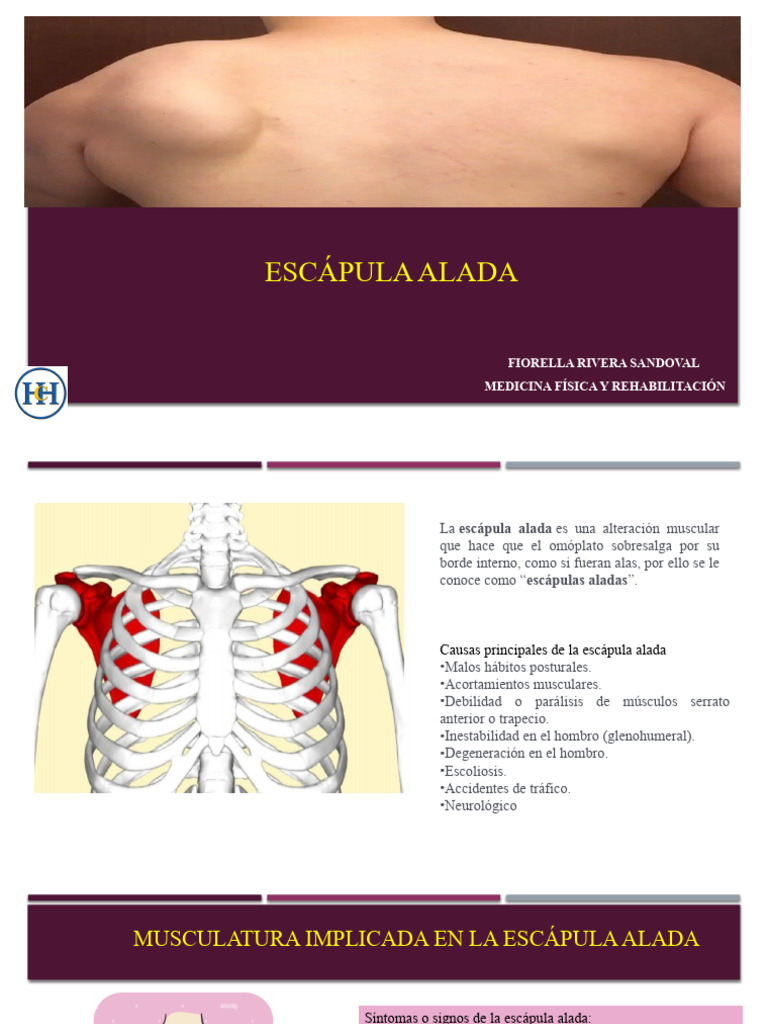 Escapula Alada | PDF | Hombro | Sistema musculoesquelético